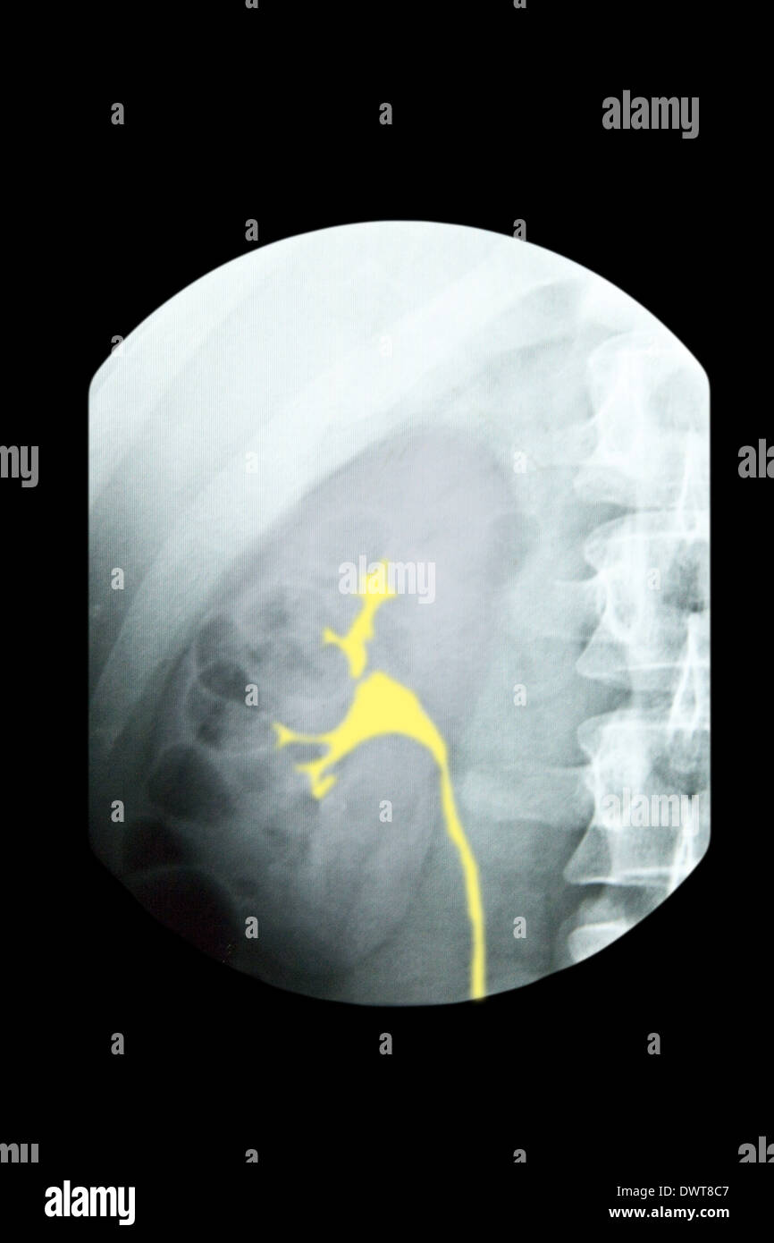 Kidney x ray Stock Photo - Alamy
