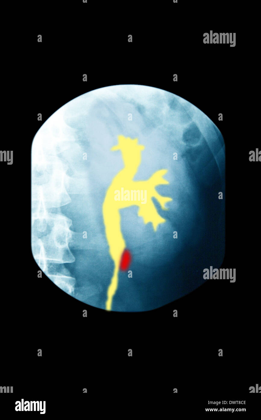 Kidney stone x ray Stock Photo - Alamy