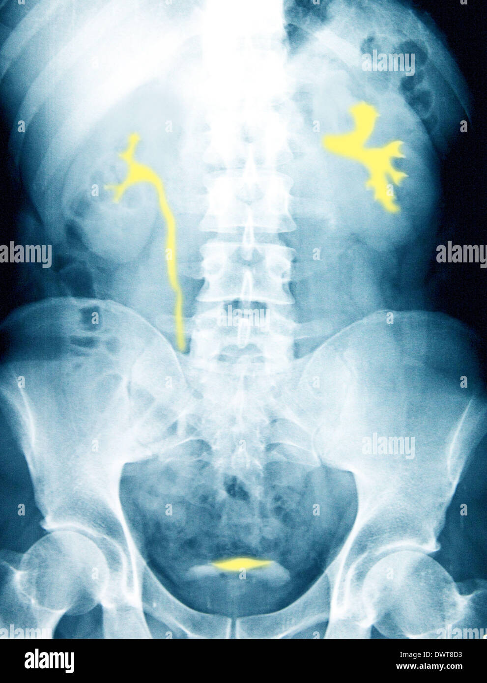 Urinary system x ray Stock Photo - Alamy