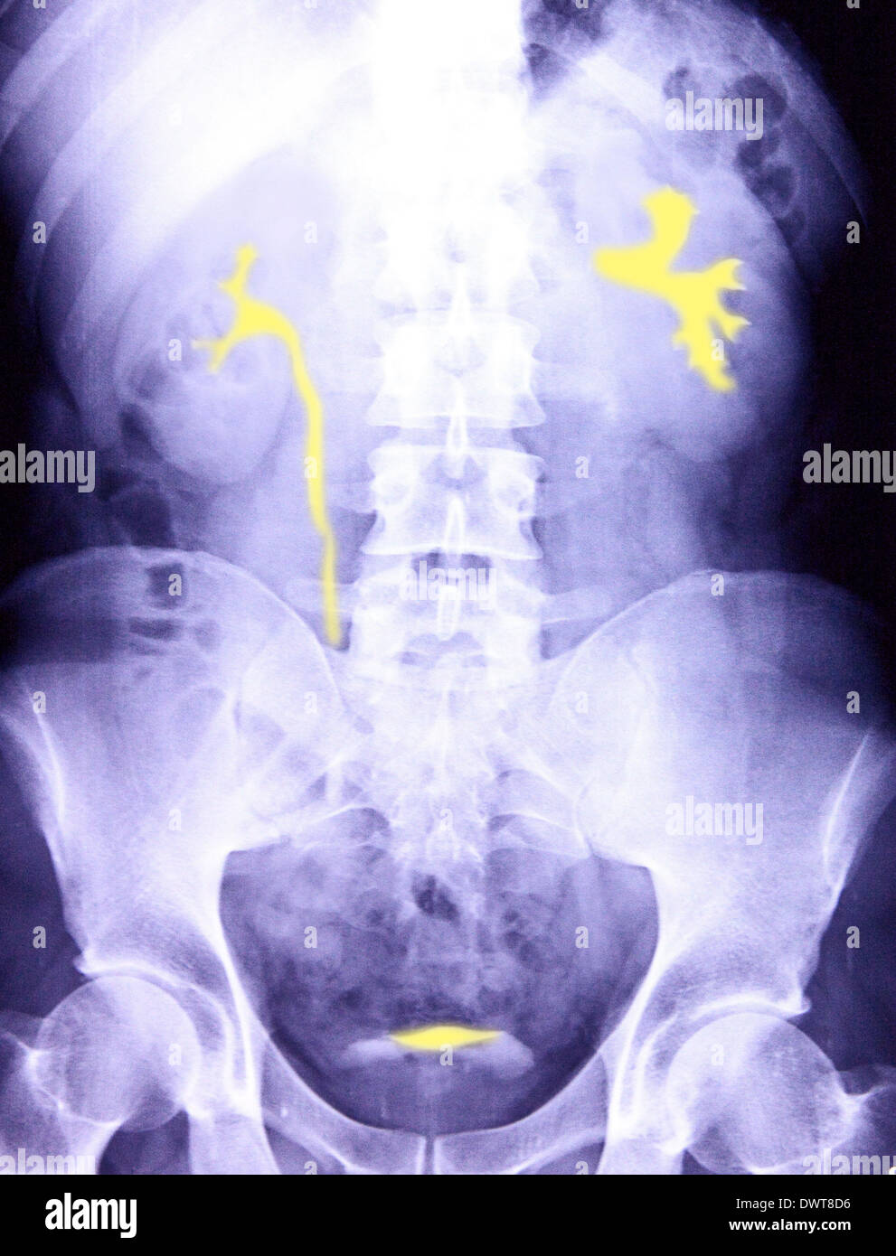 Urinary system x ray Stock Photo - Alamy