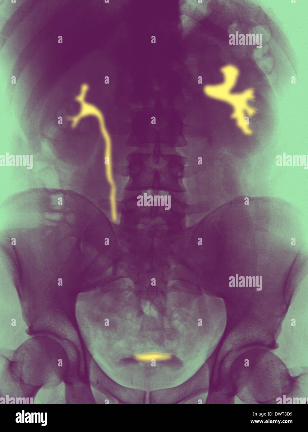 Urinary system x ray hi-res stock photography and images - Alamy