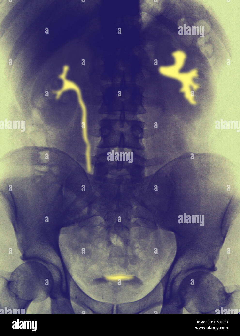 Urinary system x ray Stock Photo - Alamy