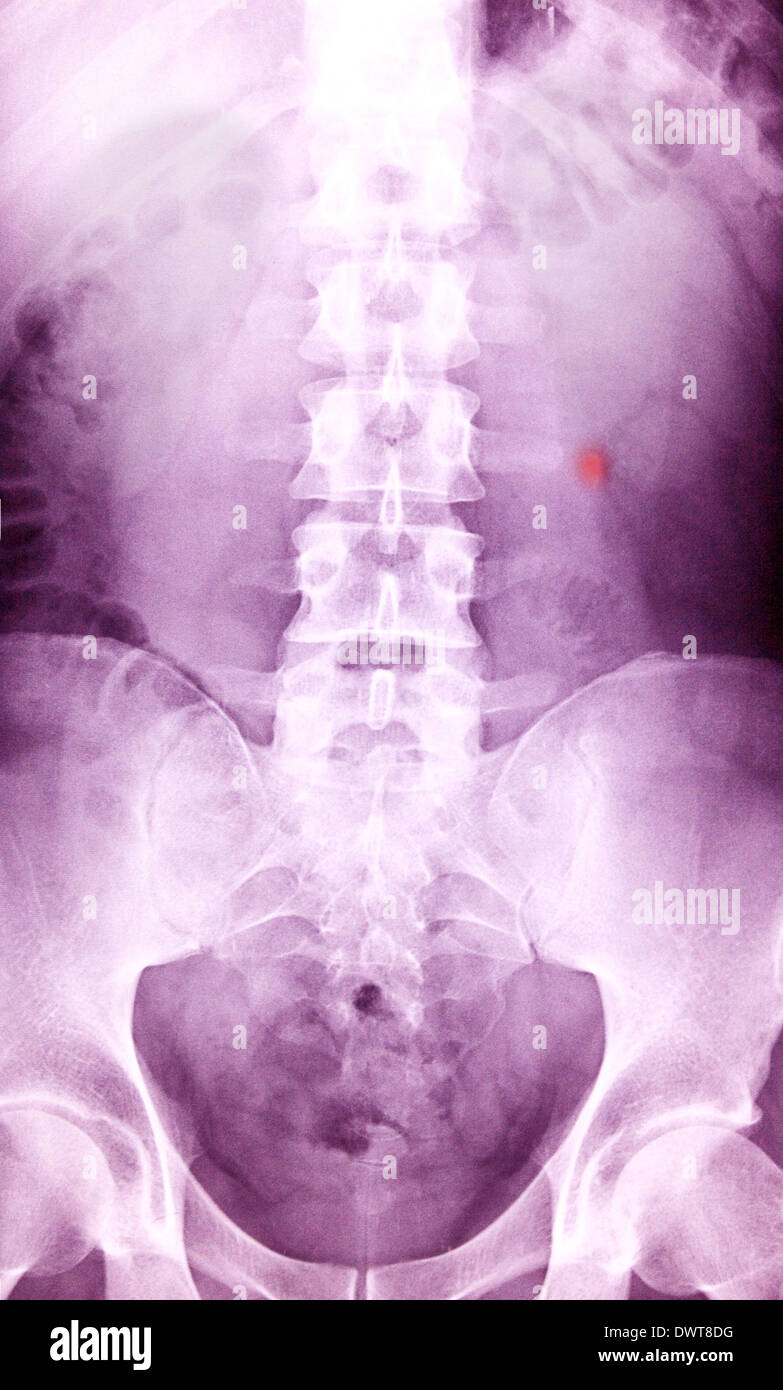 Kidney stone x ray Stock Photo - Alamy