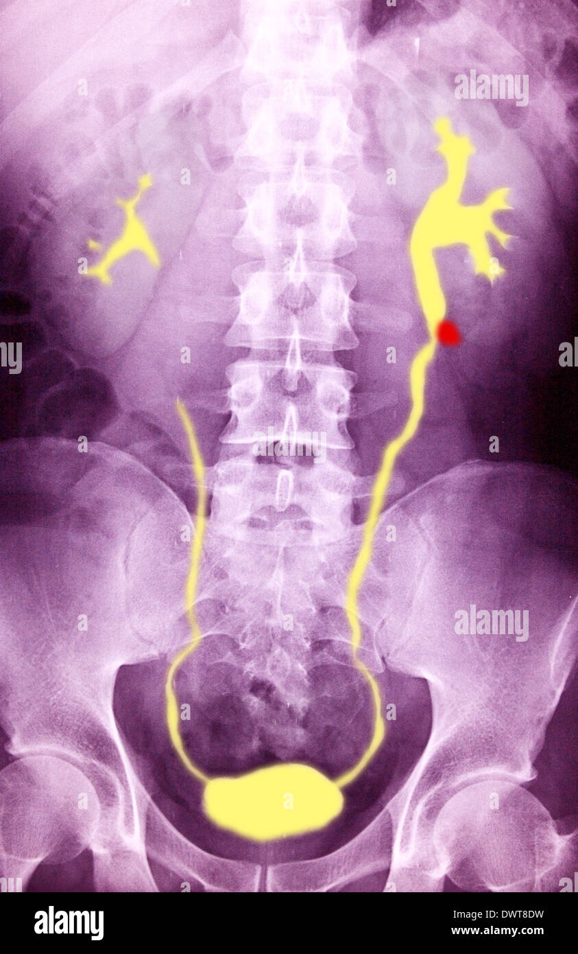 Ivp kidney stone hi-res stock photography and images - Alamy
