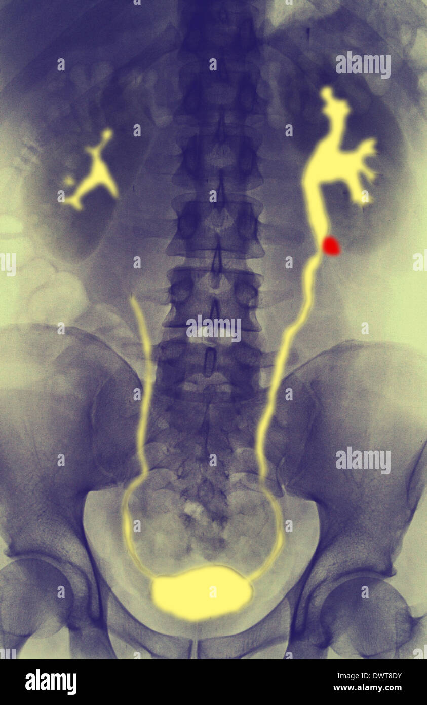 Kidney stone x ray Stock Photo - Alamy