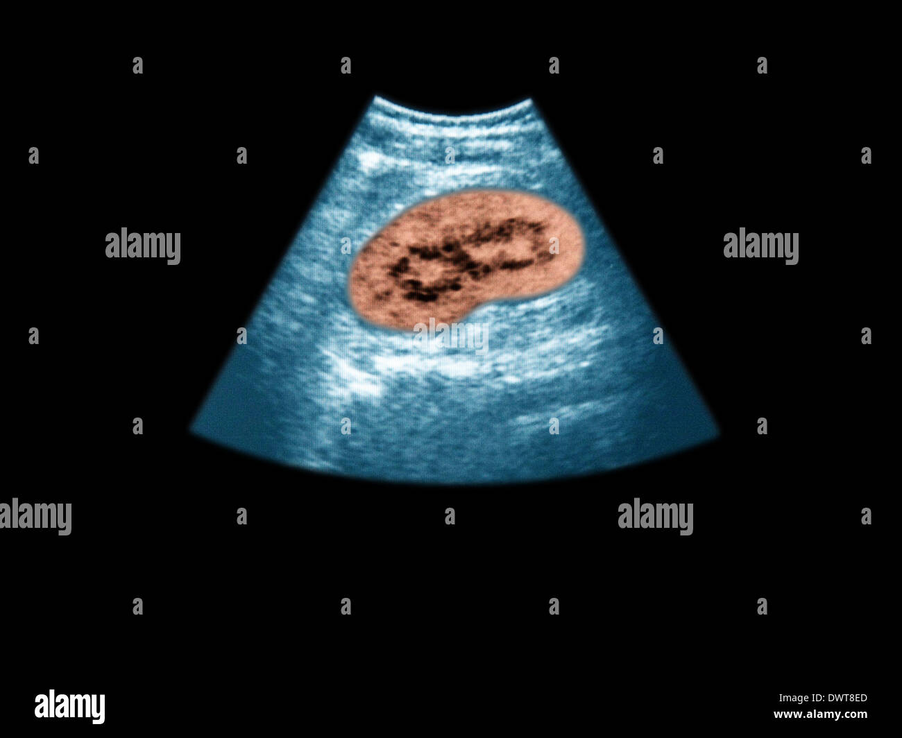 Kidney ultrasound scan Stock Photo - Alamy