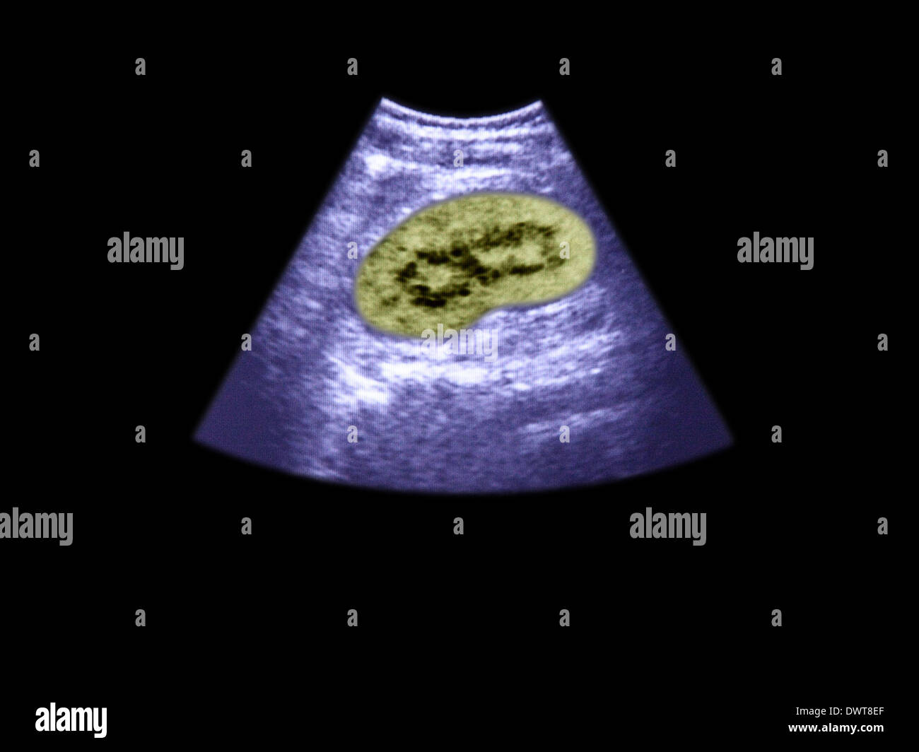Kidney ultrasound scan Stock Photo - Alamy