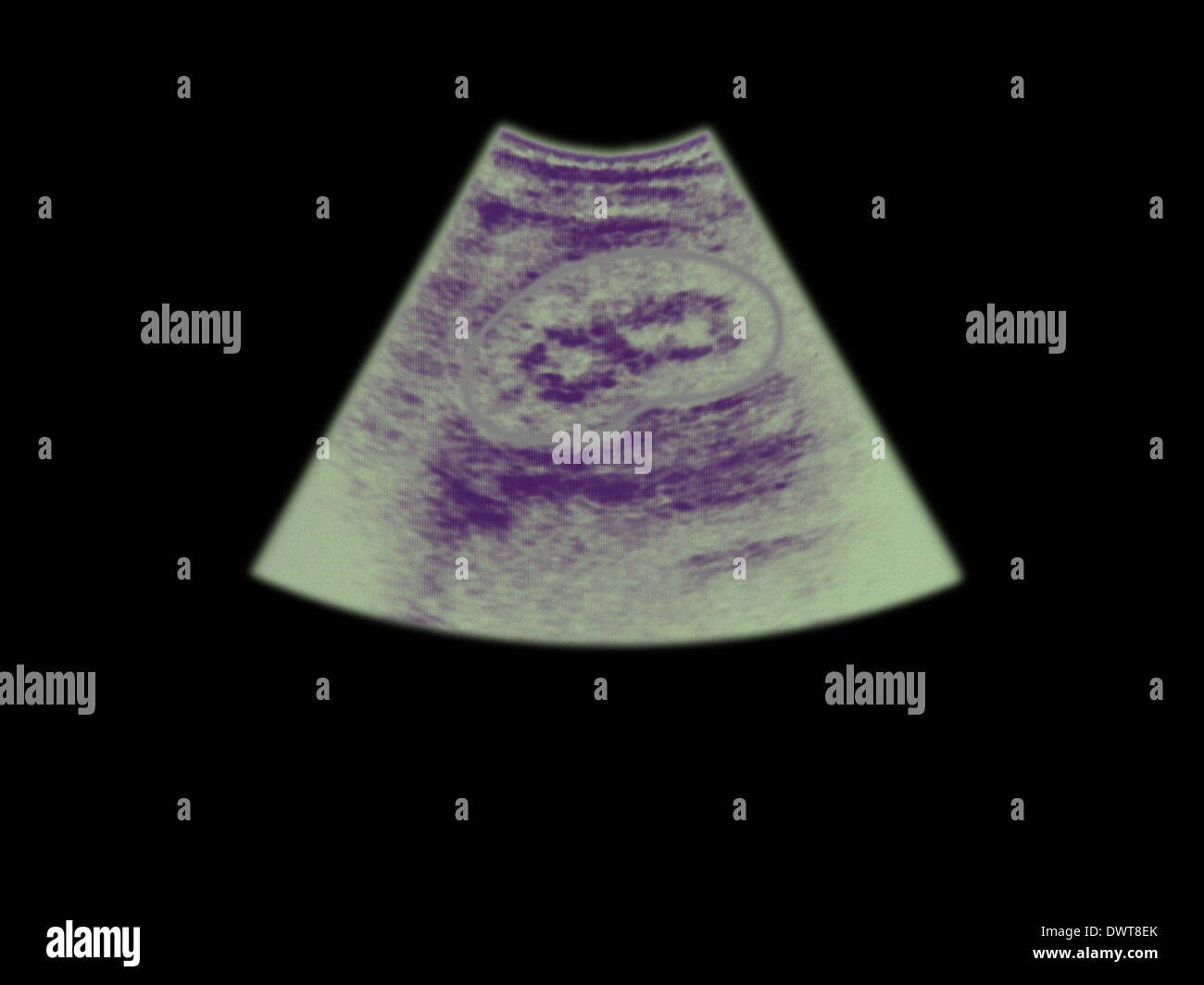 Kidney ultrasound scan Stock Photo - Alamy