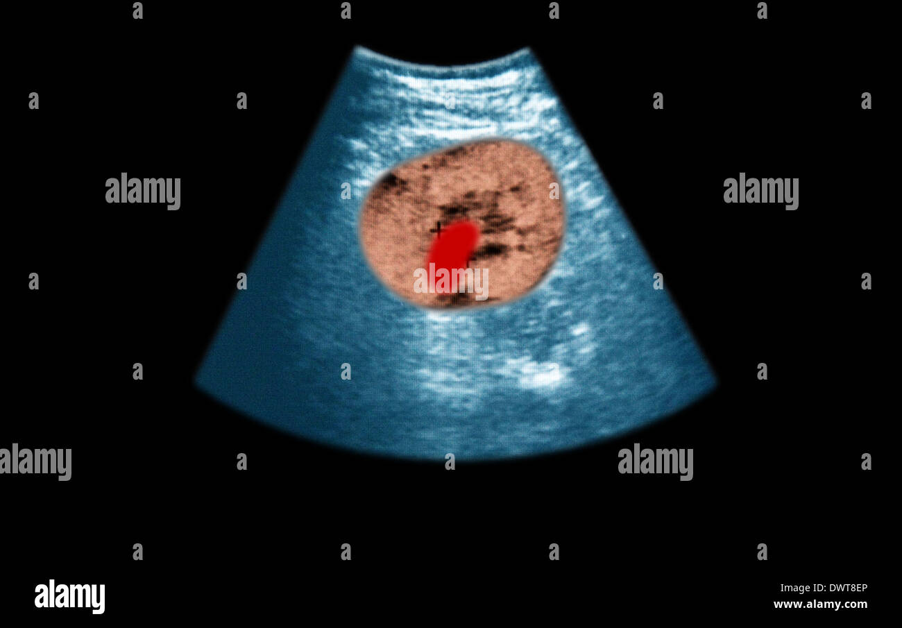 Ultrasound kidney stone hi-res stock photography and images - Alamy
