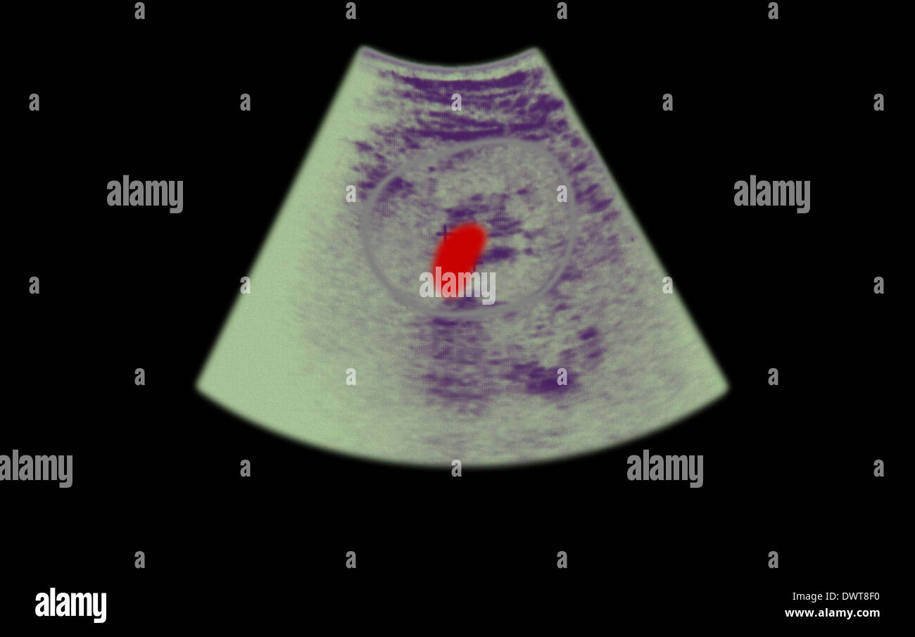 Nephrolithiasis Ultrasound