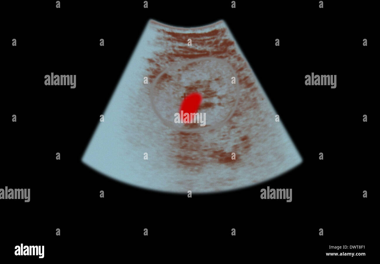 Kidney stone ultrasound scan Stock Photo - Alamy