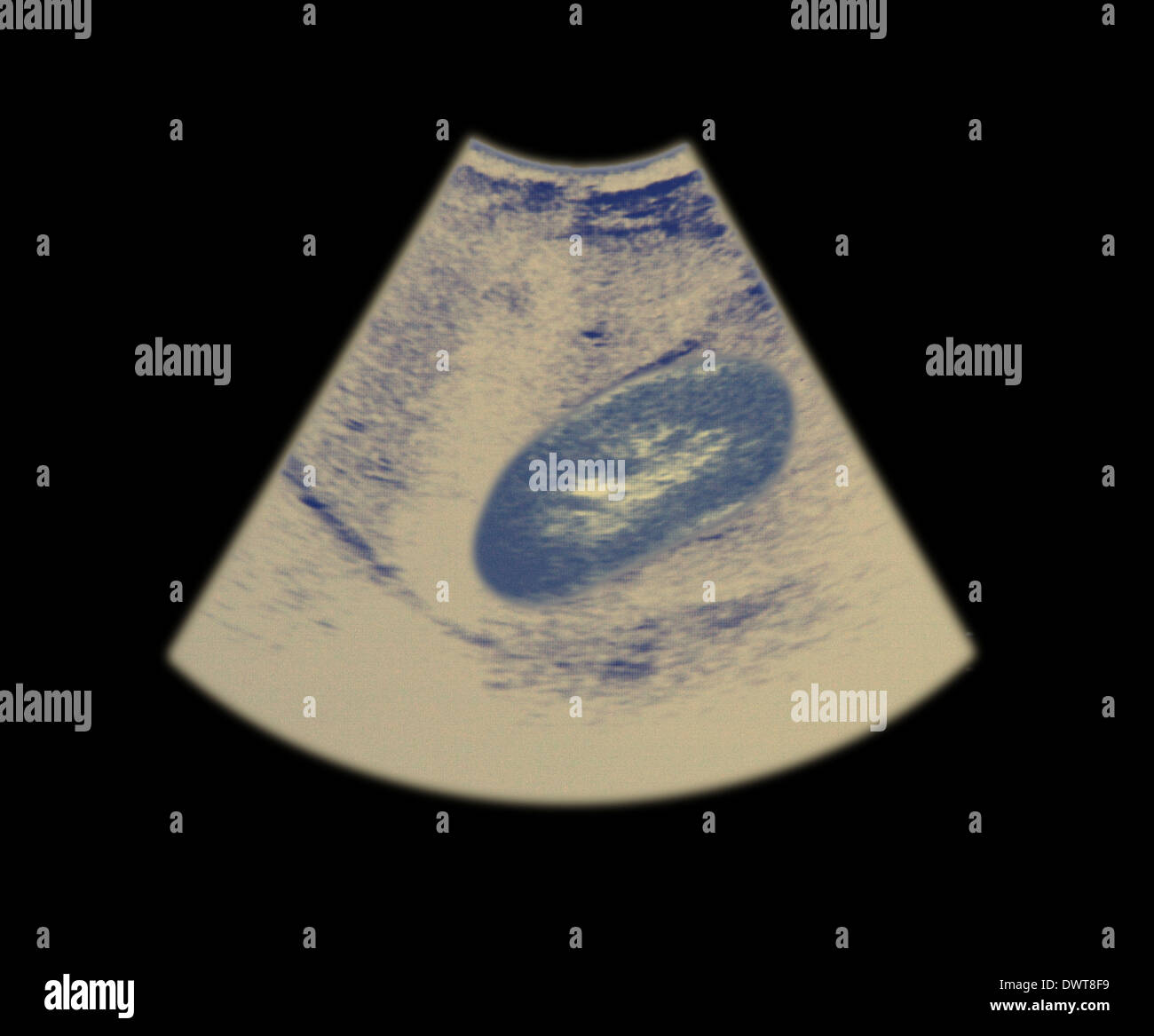 Kidney ultrasound scan Stock Photo - Alamy