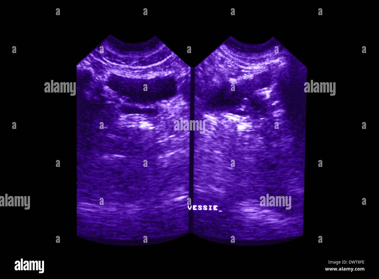 Bladder ultrasound scan Stock Photo - Alamy