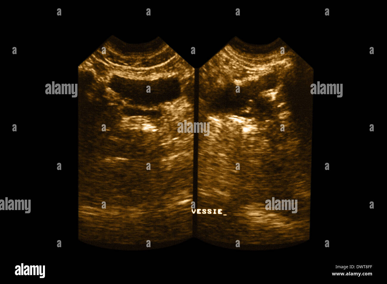 Bladder ultrasound scan Stock Photo - Alamy