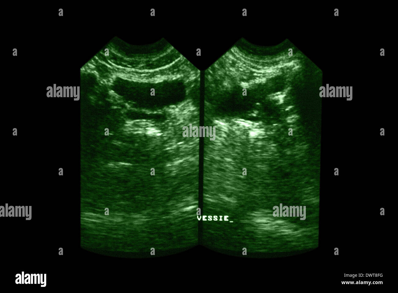 Bladder ultrasound scan Stock Photo - Alamy