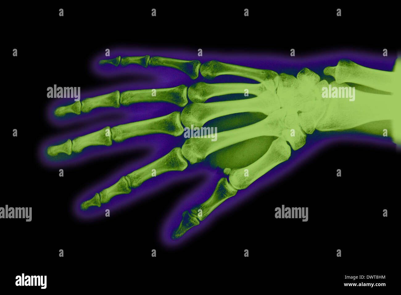 Hand x ray Stock Photo - Alamy