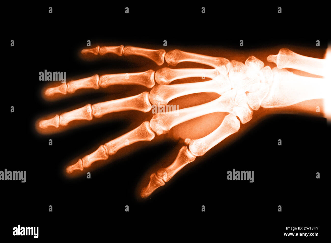 Hand x ray Stock Photo - Alamy