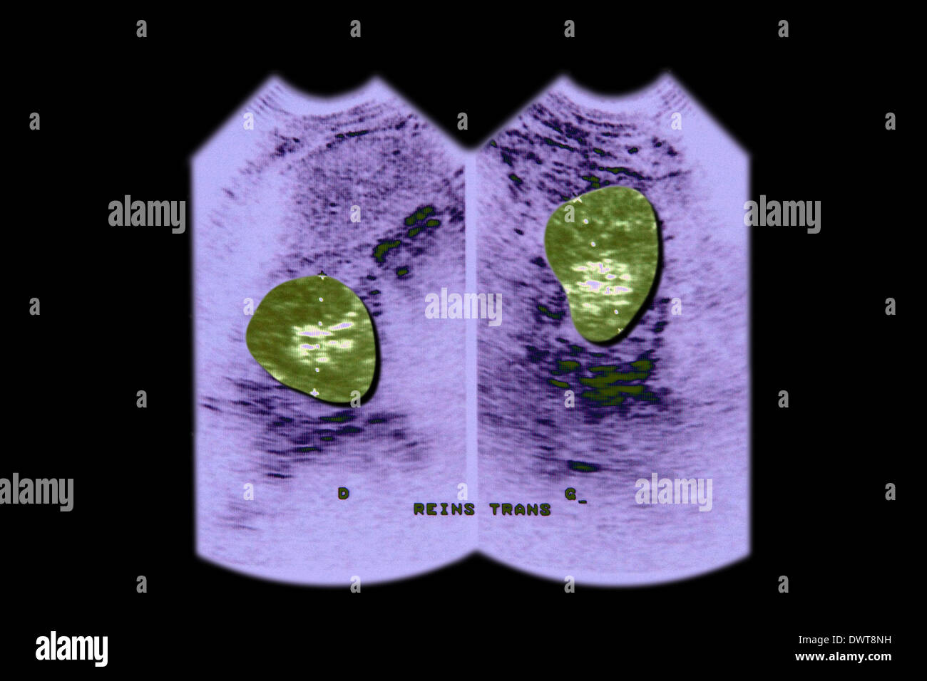 Kidney ultrasound scan Stock Photo - Alamy