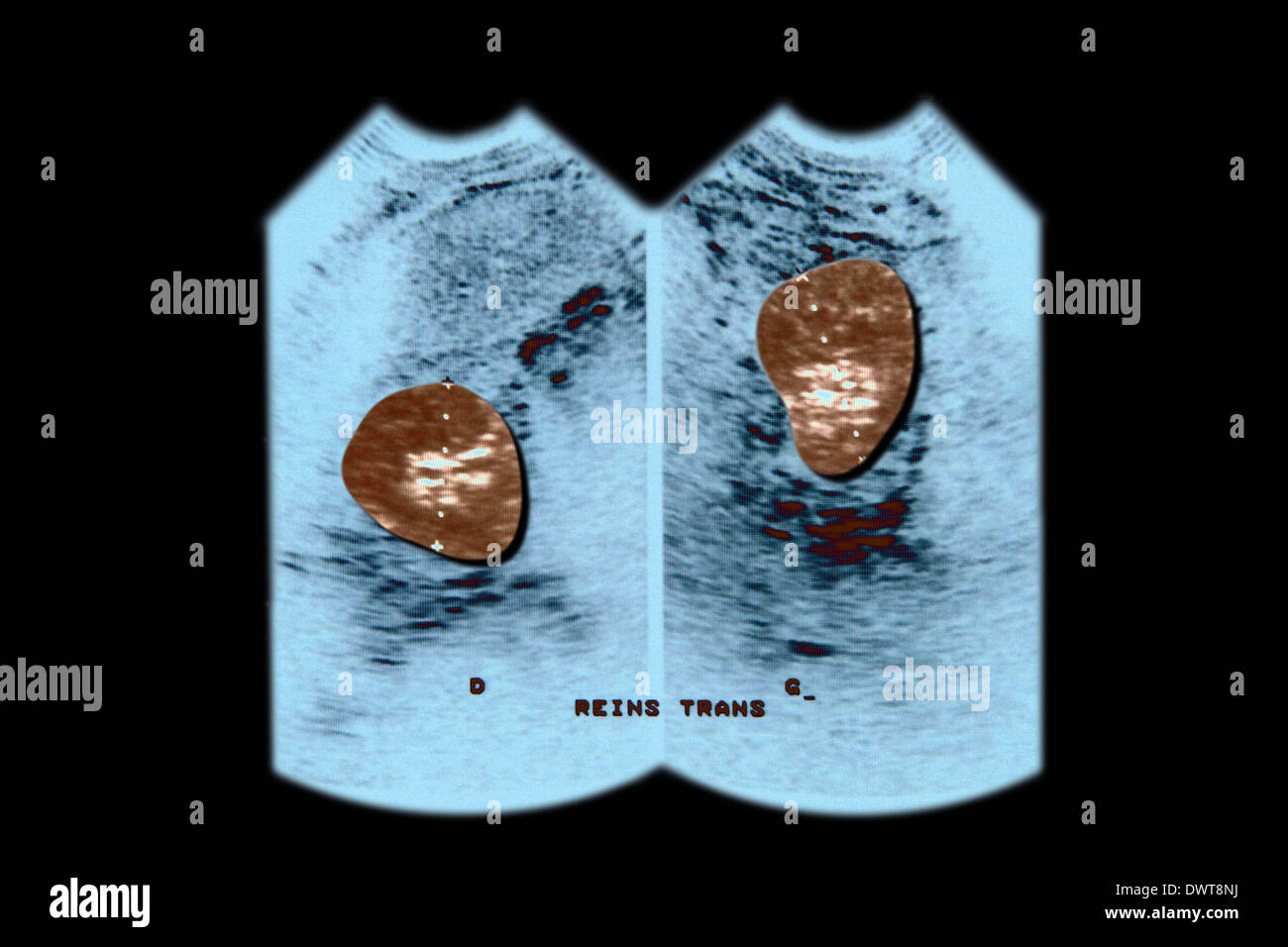 Kidney ultrasound scan Stock Photo - Alamy