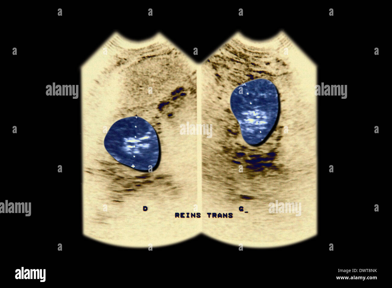 Kidney ultrasound scan Stock Photo - Alamy