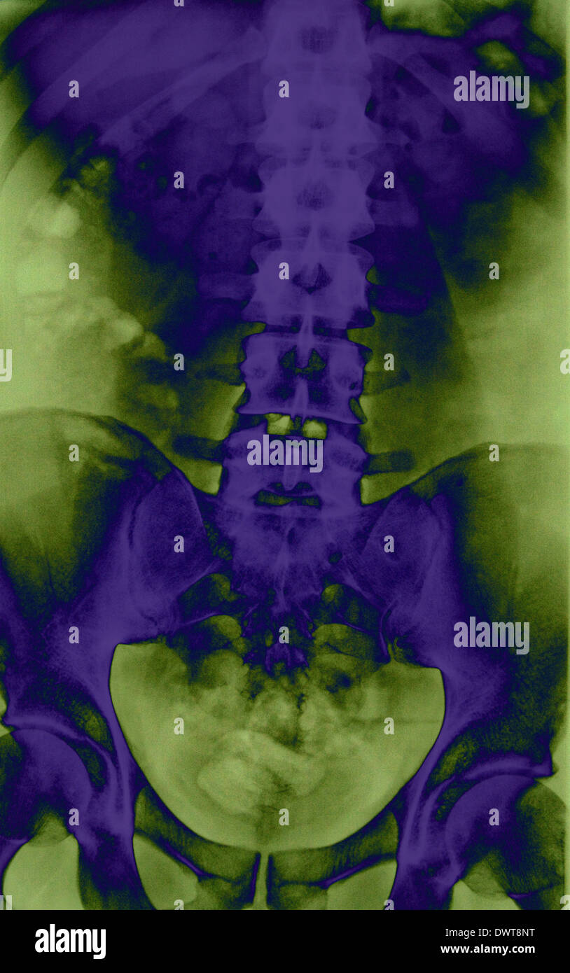 Bladder x ray Stock Photo - Alamy