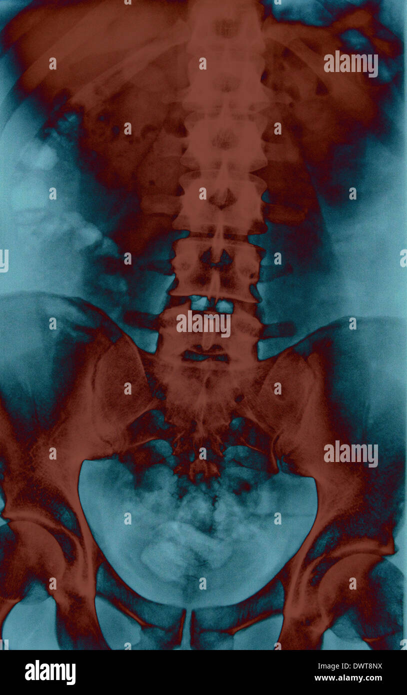 Bladder x ray Stock Photo - Alamy