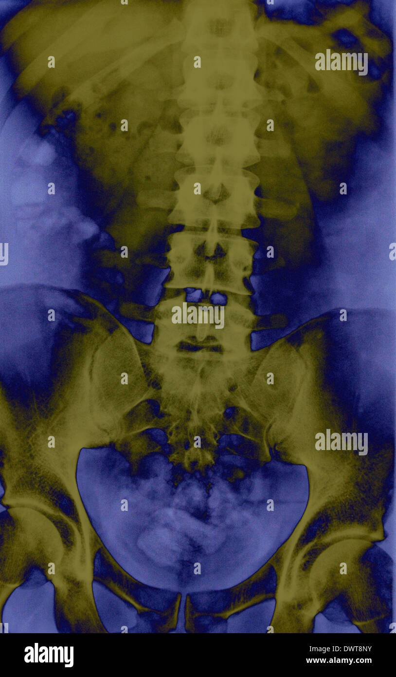 Bladder x ray Stock Photo - Alamy