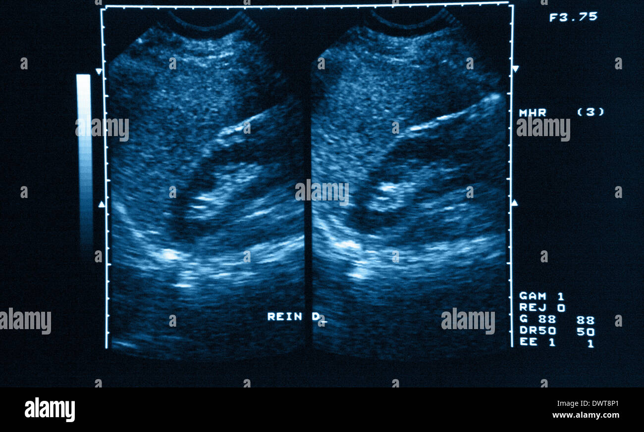 Kidney ultrasound scan Stock Photo - Alamy