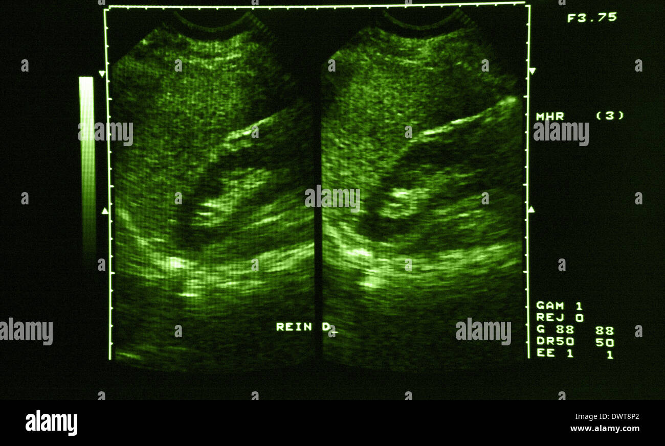 Kidney ultrasound scan Stock Photo - Alamy