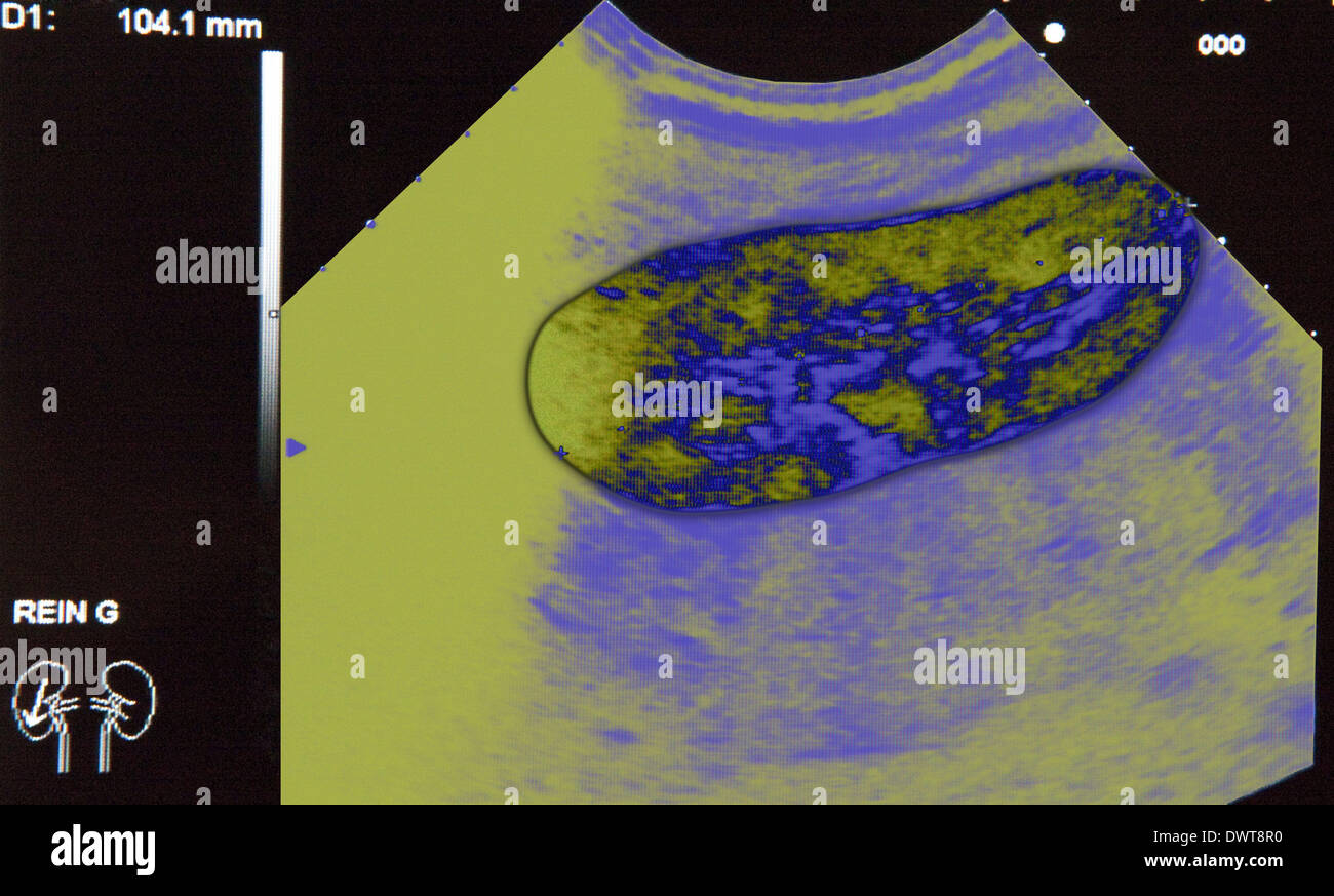 Ultrasound kidney renal hi-res stock photography and images - Alamy