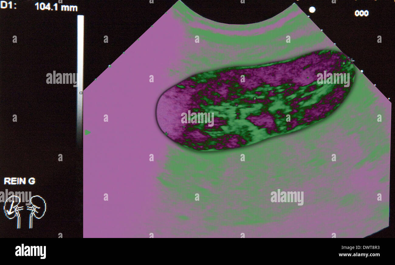 Kidney ultrasound scan Stock Photo - Alamy