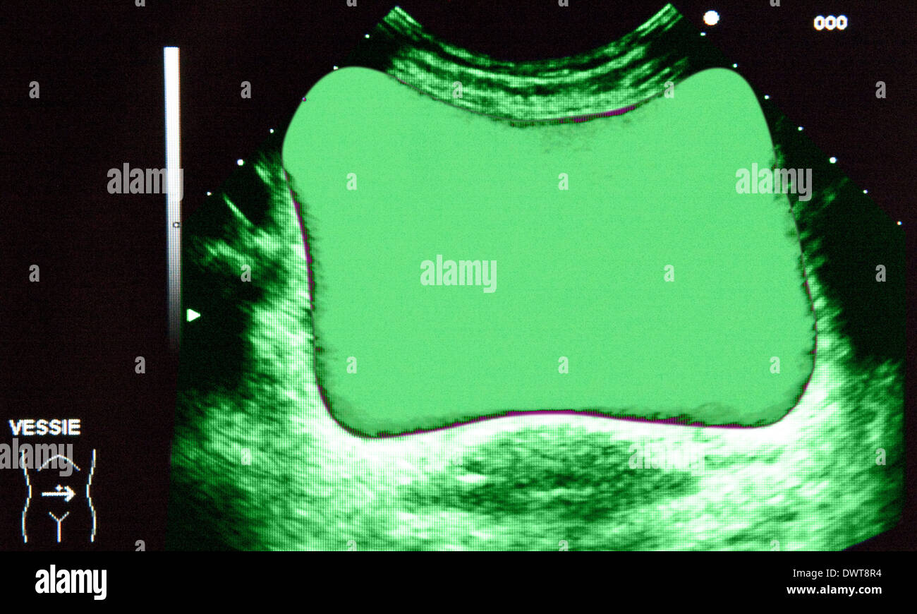 Bladder ultrasound scan Stock Photo - Alamy