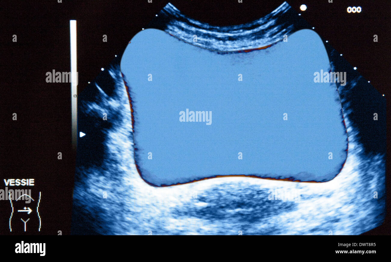 Bladder ultrasound scan Stock Photo - Alamy