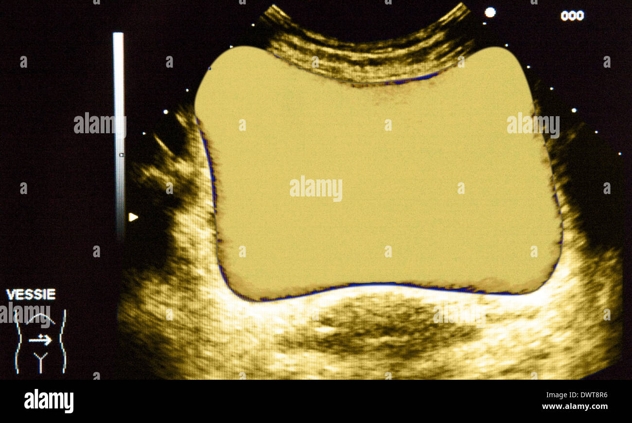 Bladder ultrasound scan Stock Photo - Alamy