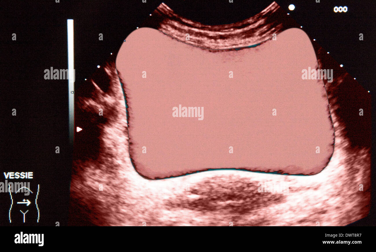 Bladder ultrasound scan Stock Photo - Alamy