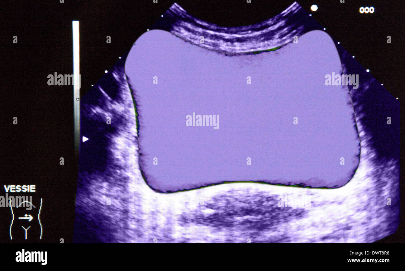 Bladder ultrasound scan Stock Photo - Alamy