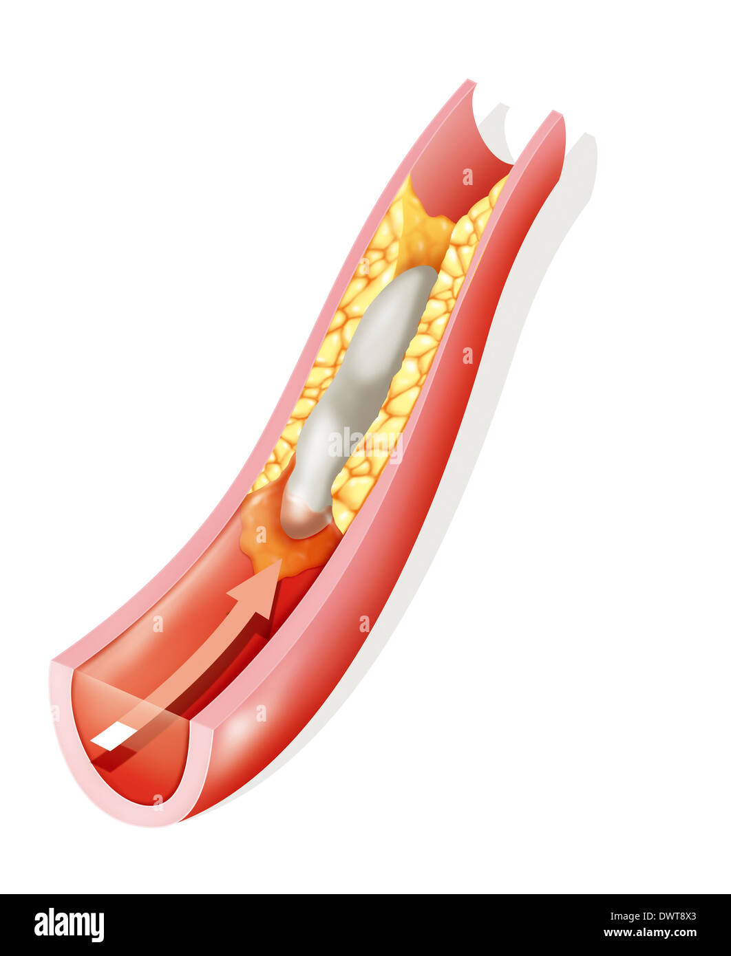 Arterial thrombosis drawing hi-res stock photography and images - Alamy