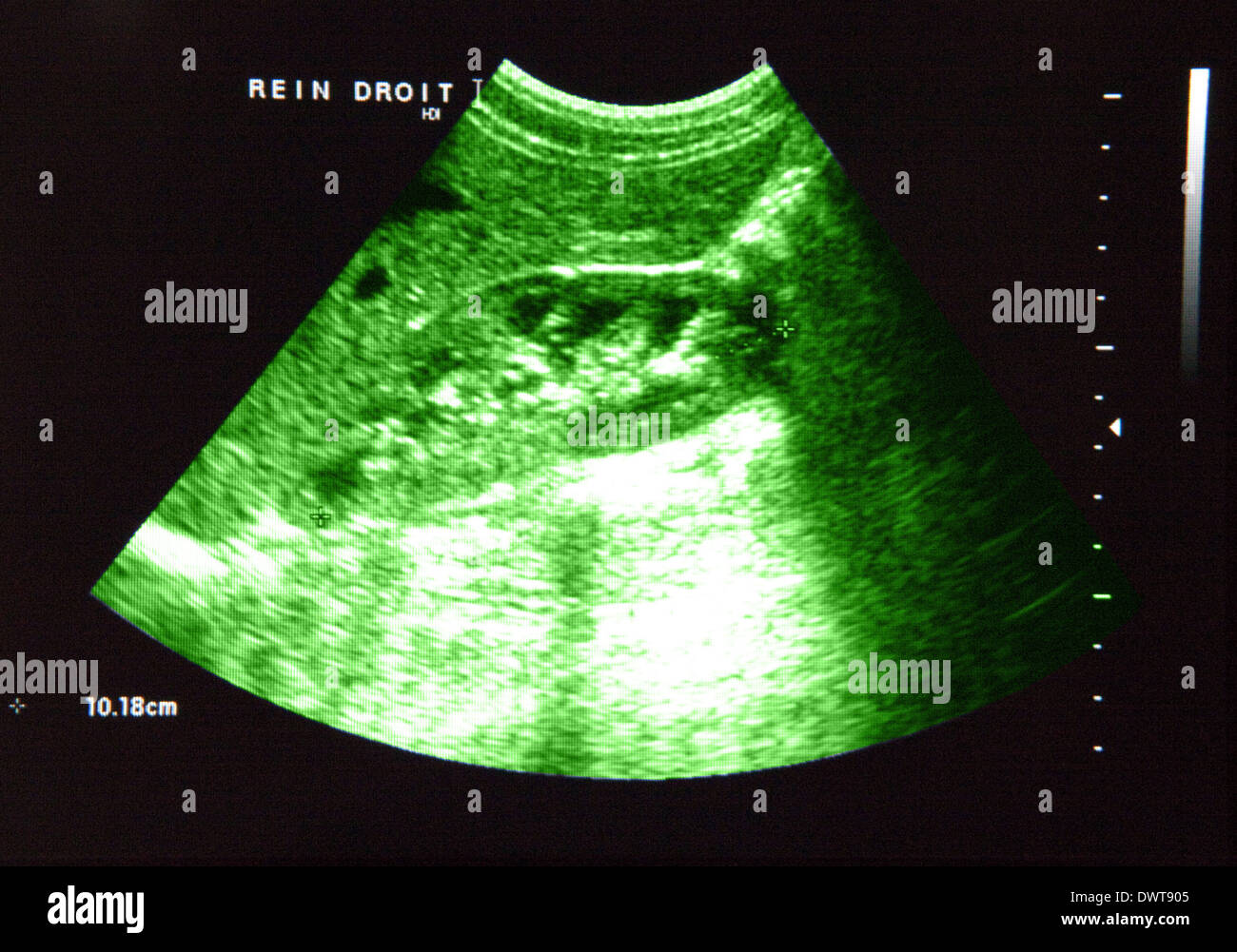 Kidney ultrasound scan Stock Photo - Alamy