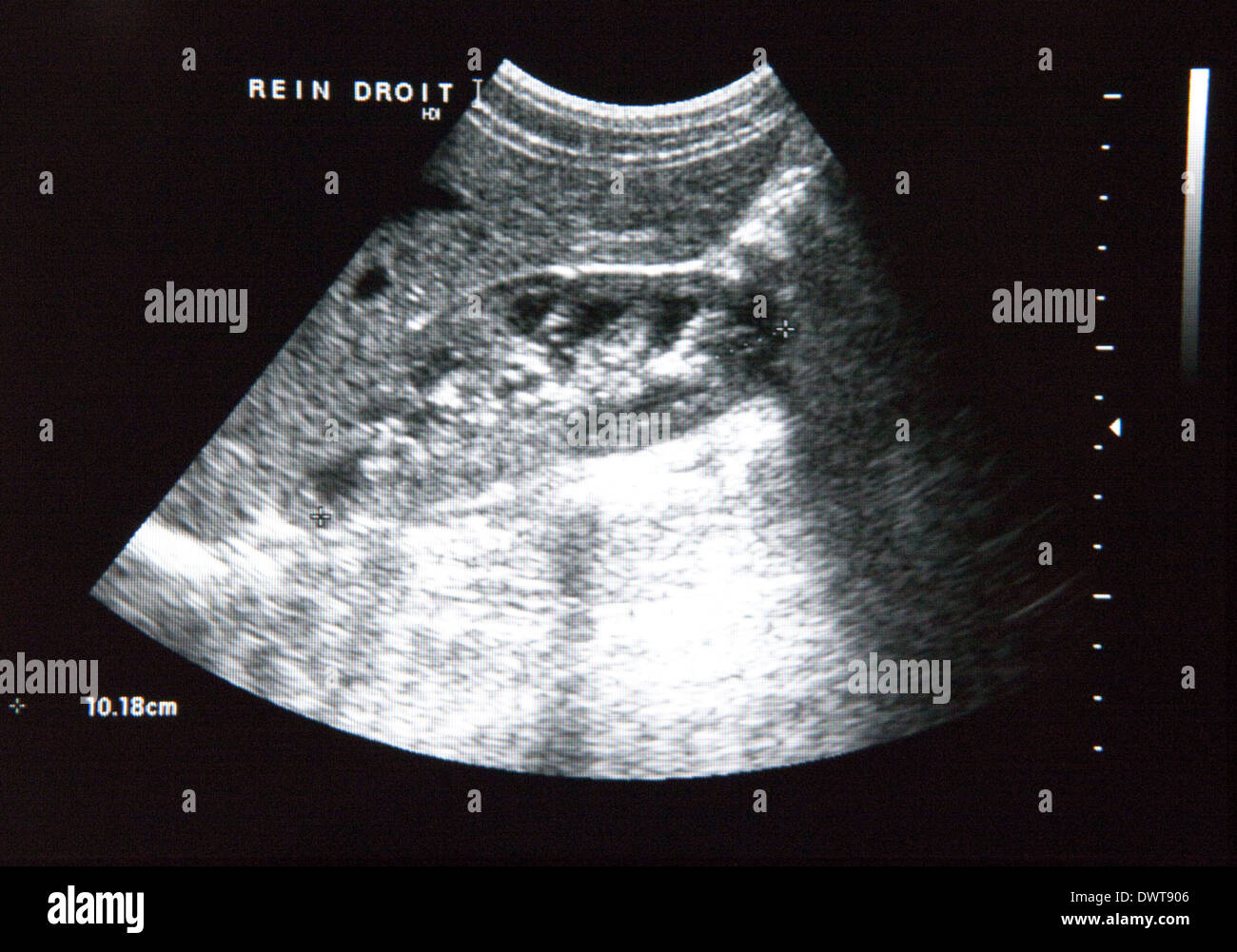 Kidney ultrasound scan Stock Photo - Alamy