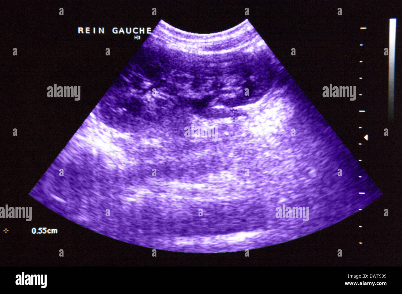 Kidney ultrasound scan Stock Photo - Alamy