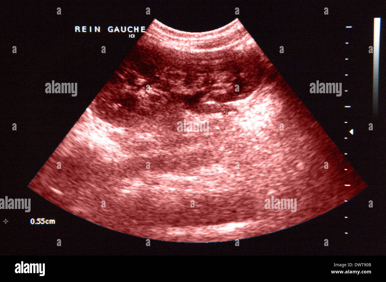 Kidney ultrasound scan Stock Photo - Alamy
