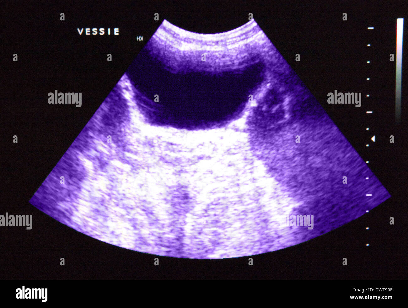 Bladder ultrasound scan Stock Photo - Alamy