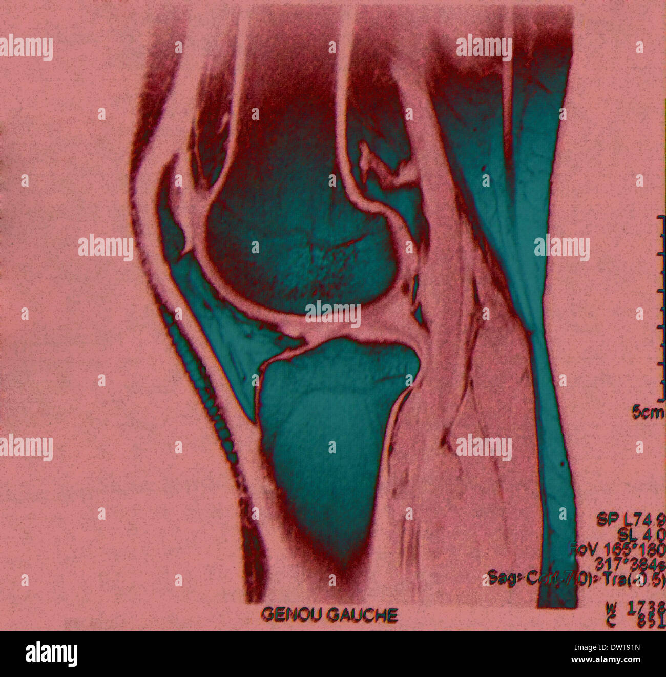 External meniscus hi-res stock photography and images - Alamy