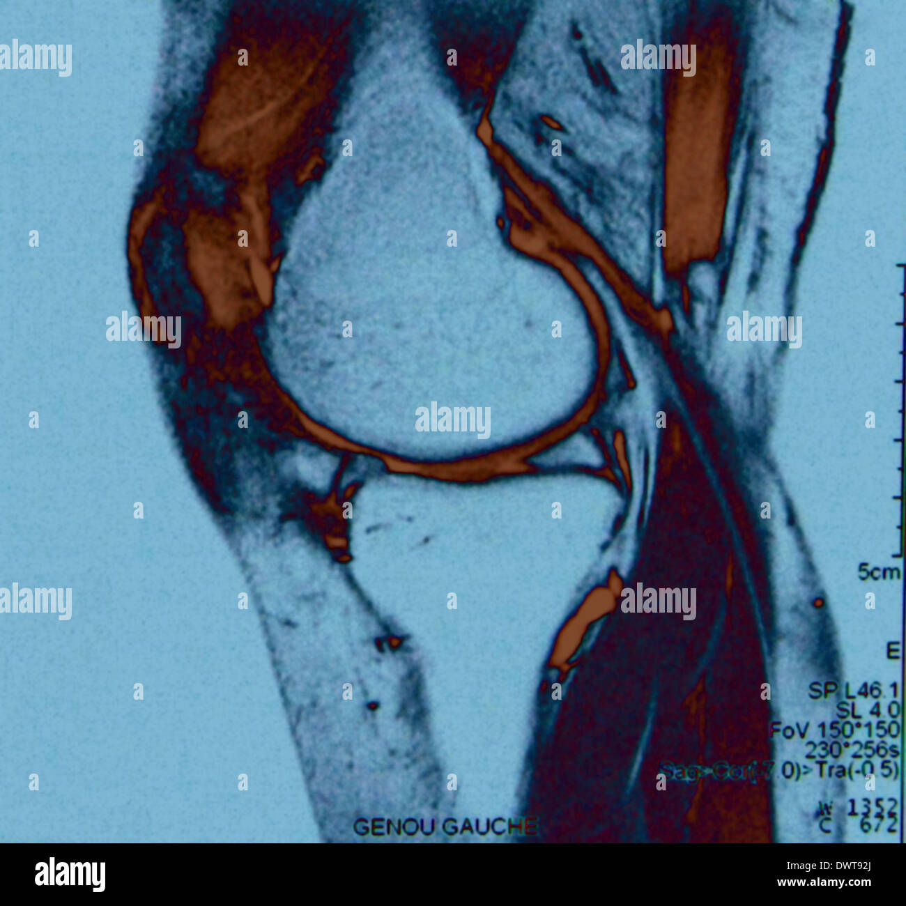 Meniscus mri hi-res stock photography and images - Alamy