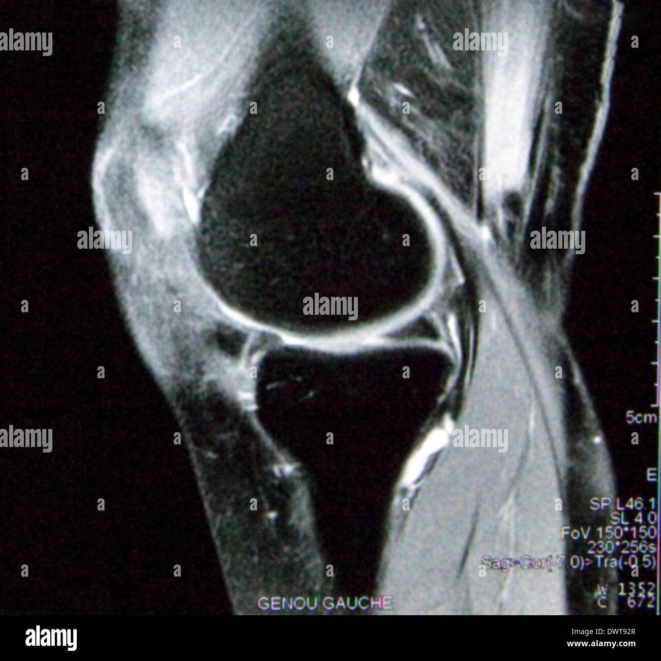 Meniscus mri hi-res stock photography and images - Alamy