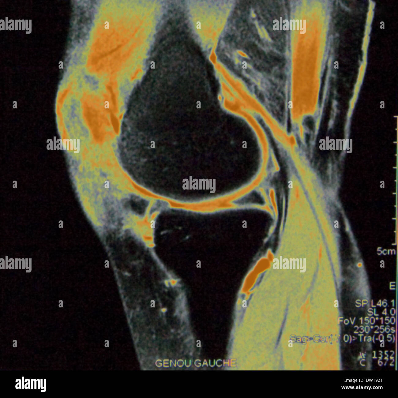 Meniscus mri hi-res stock photography and images - Alamy