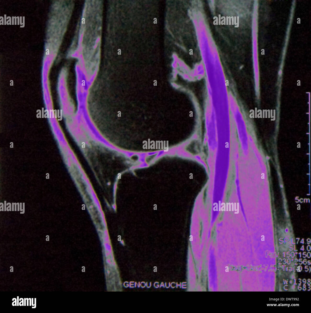 External meniscus hi-res stock photography and images - Alamy