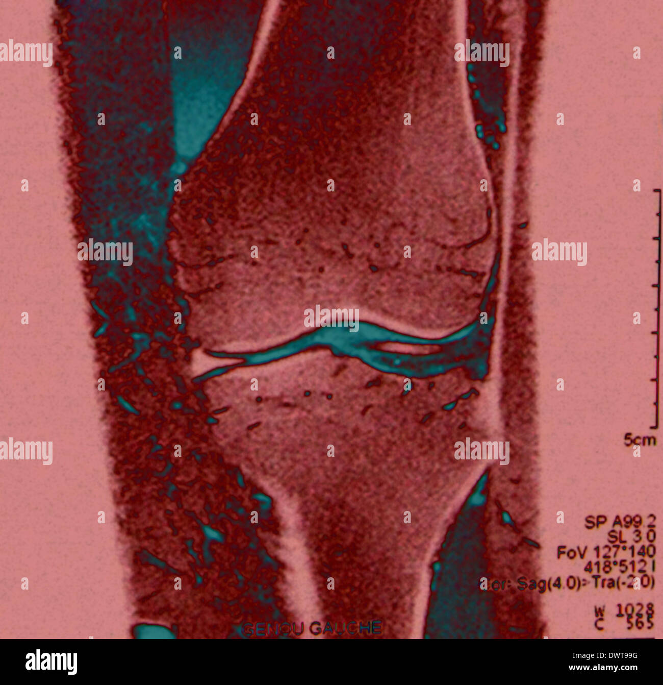Meniscus mri hi-res stock photography and images - Alamy