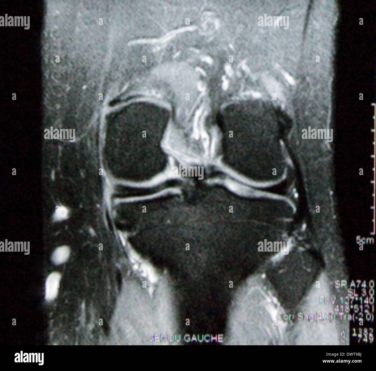 Knee mri fibula hi-res stock photography and images - Alamy