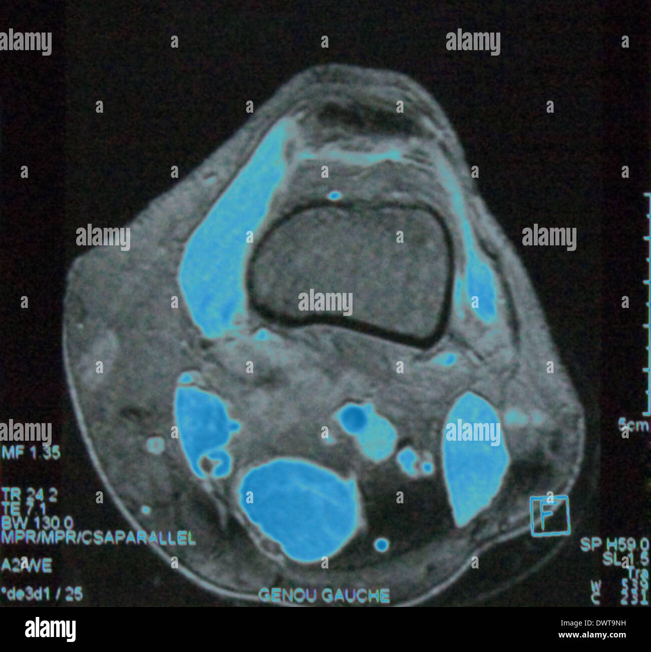 Musculus biceps femoris hi-res stock photography and images - Alamy